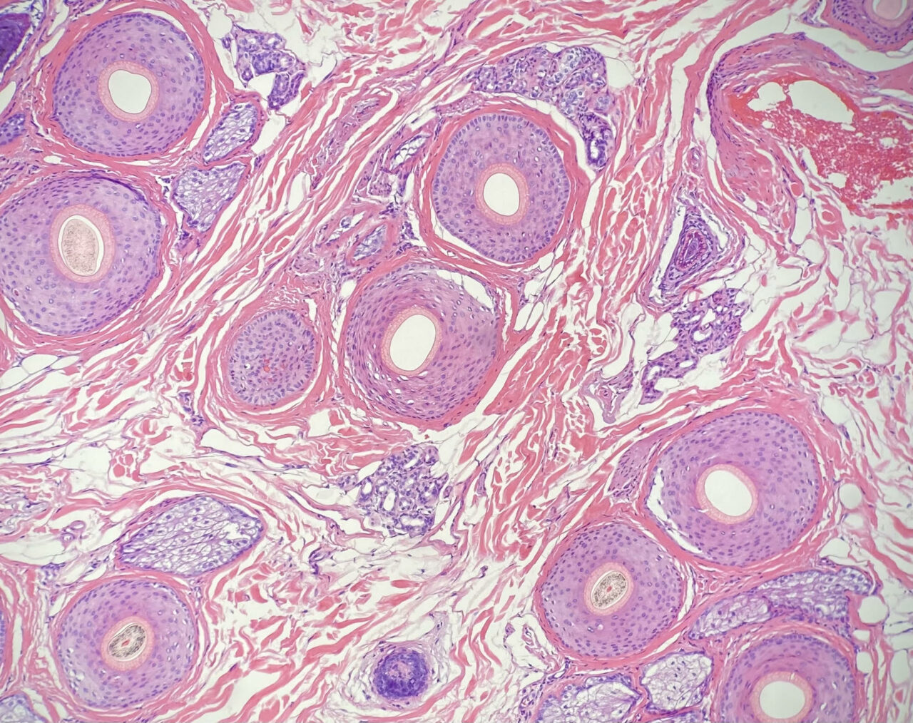 Dermatopathology | Dermatology Associates of Lancaster