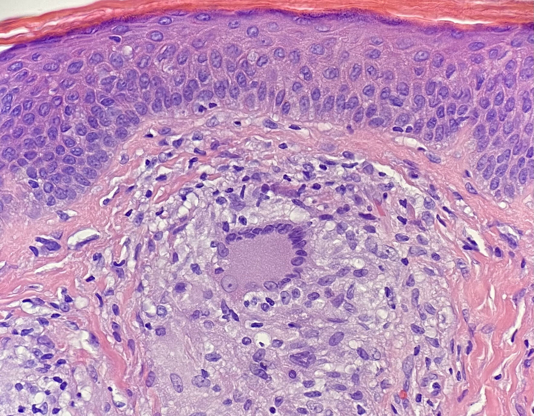 Dermatopathology | Dermatology Associates of Lancaster